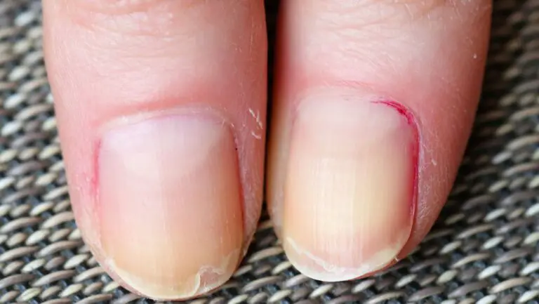 My Fingernails Keep Splitting: 8 Reasons and 7 Tips